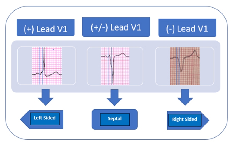 Ablation of accessory pathways: indications and contraindications